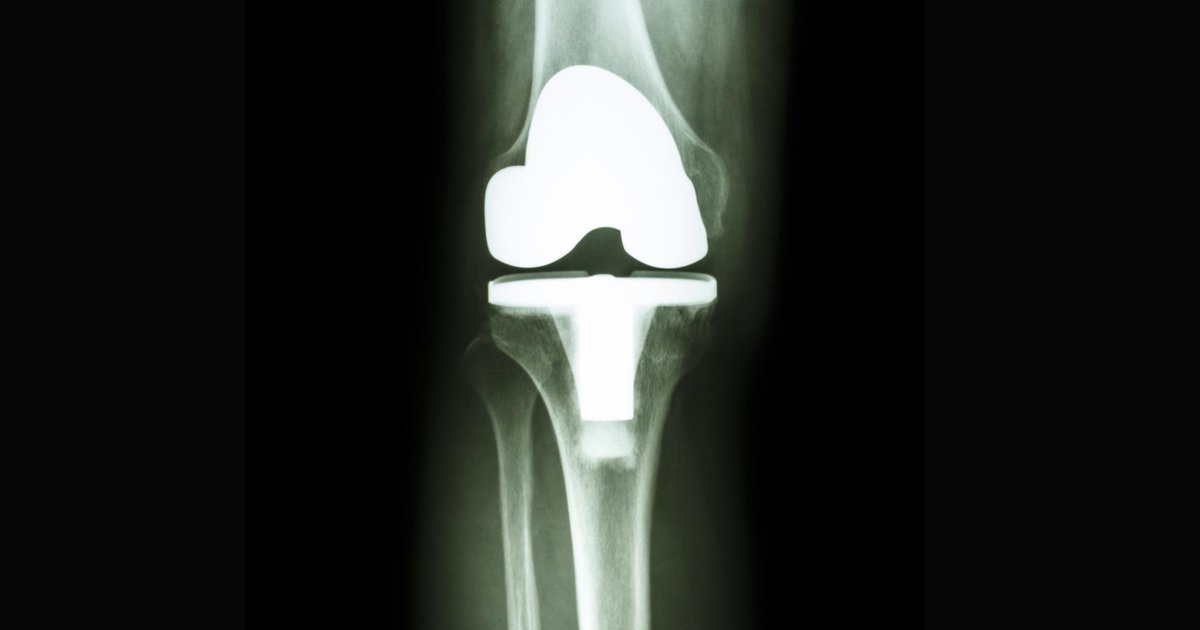 Haluaisitko polven tekonivelleikkaukseen? Lue asiantuntijan vinkit | ET